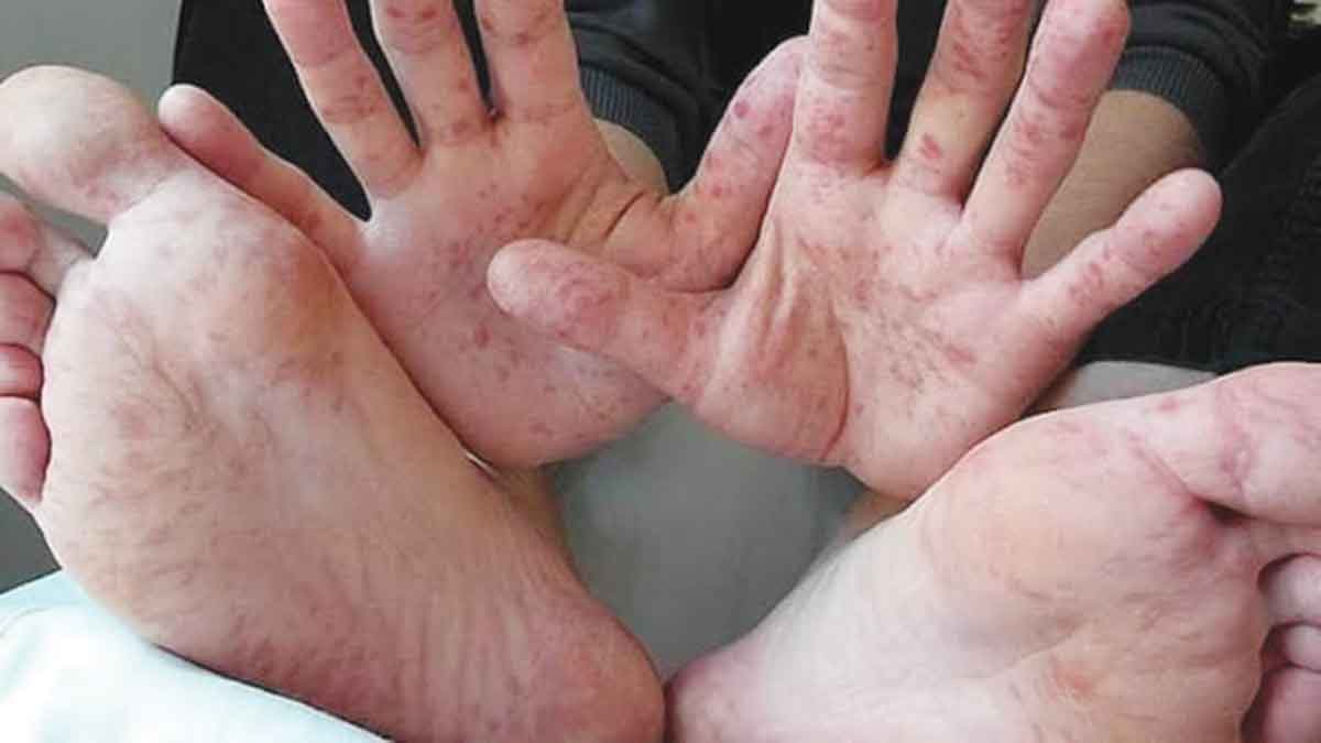 Aklan records 289 cases of hand-foot-and-mouth disease
