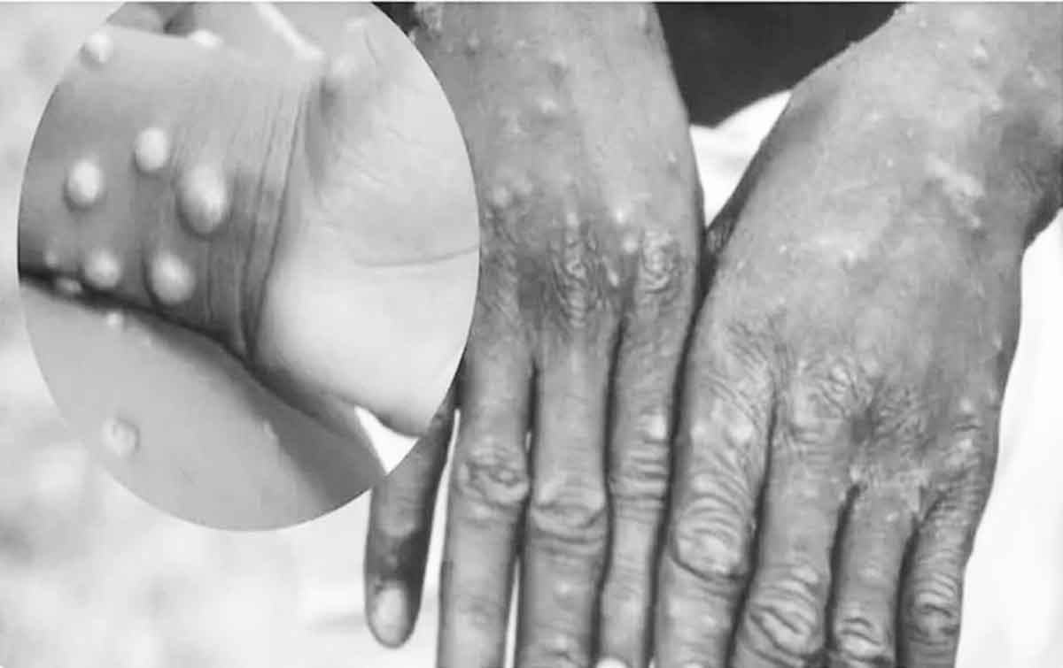 PH 4th monkeypox case an Ilonggo?