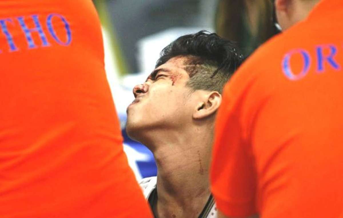 Fireworks-related injuries post 50% increase – DOH