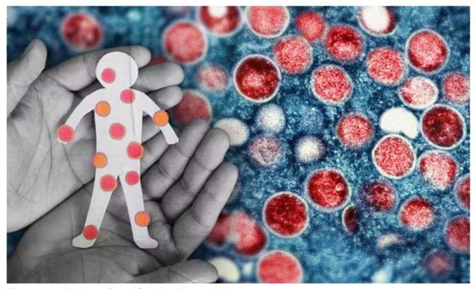 Dep’t of Health detects two more cases of mpox