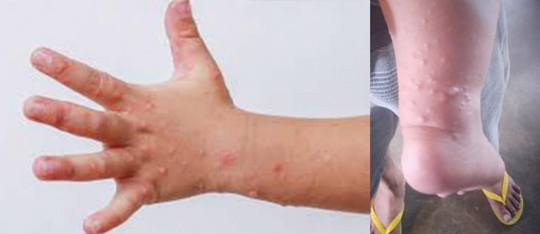 322% INCREASE: Iloilo logs 1,393 HFMD cases; health officials warn parents