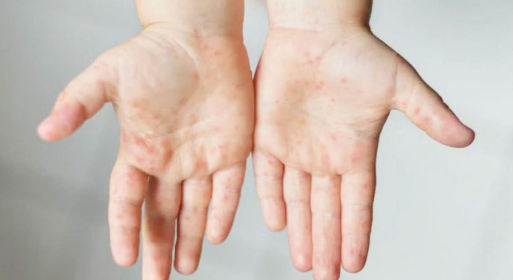 DOH cites increase in HFMD among kids
