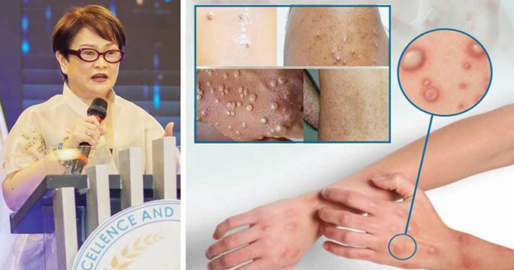 VIRAL THREAT: Mpox resurfaces in southern PH, prompts warning in Iloilo