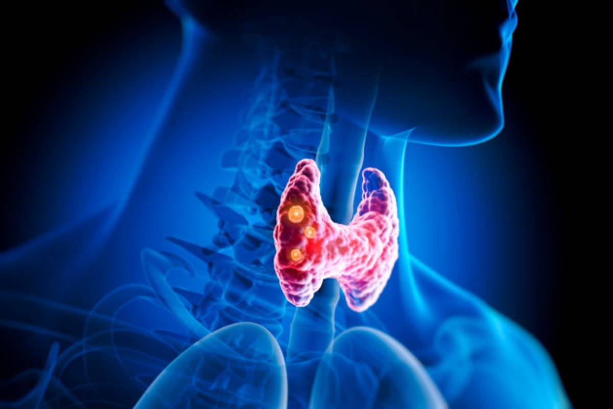 Thyroid disorders targeted in health screening rollout